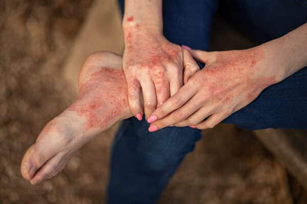 10 Common Causes Contact Dermatitis - Hollywood Dermatology