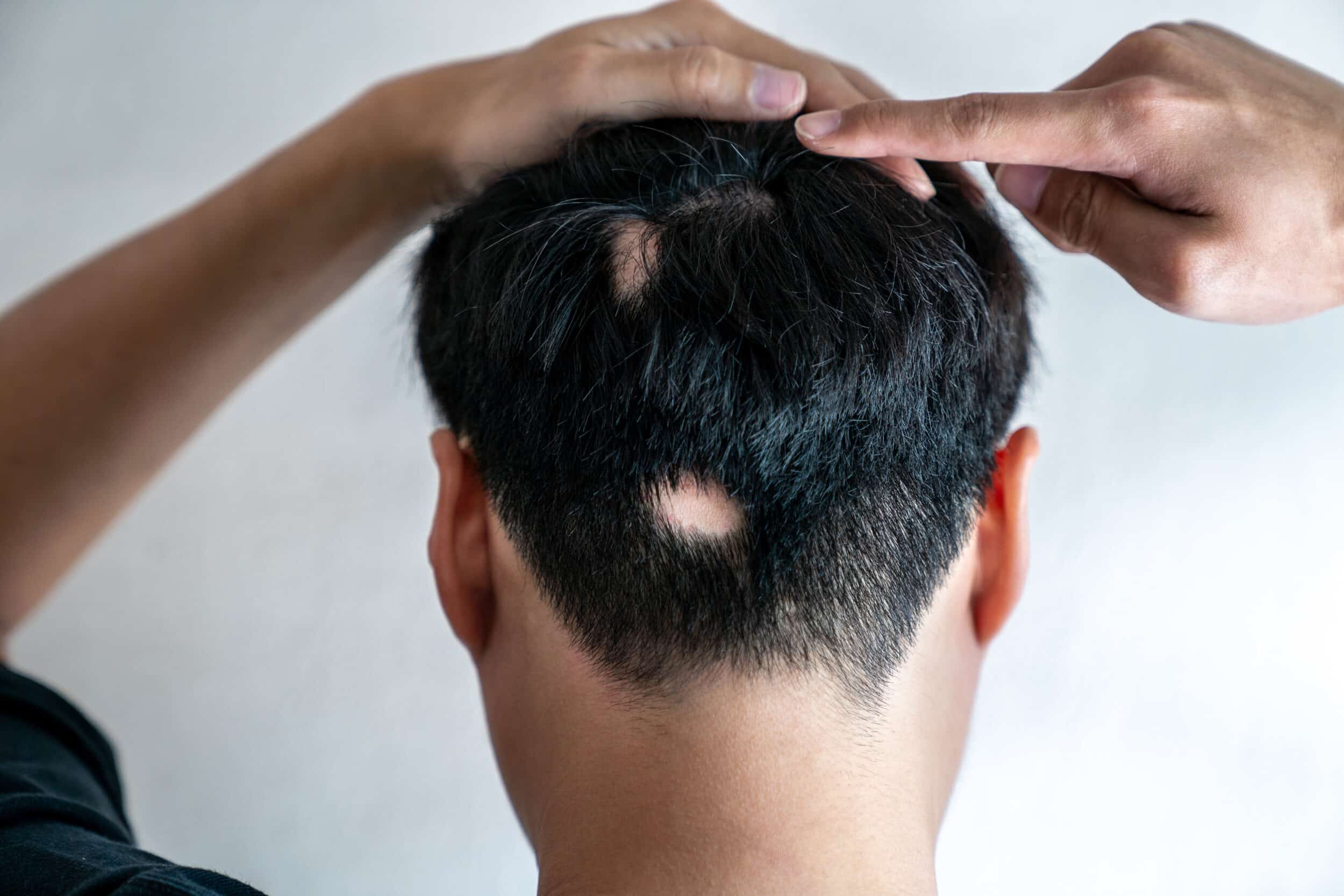 Do You Have Early Signs of Alopecia Areata in Hollywood, FL?