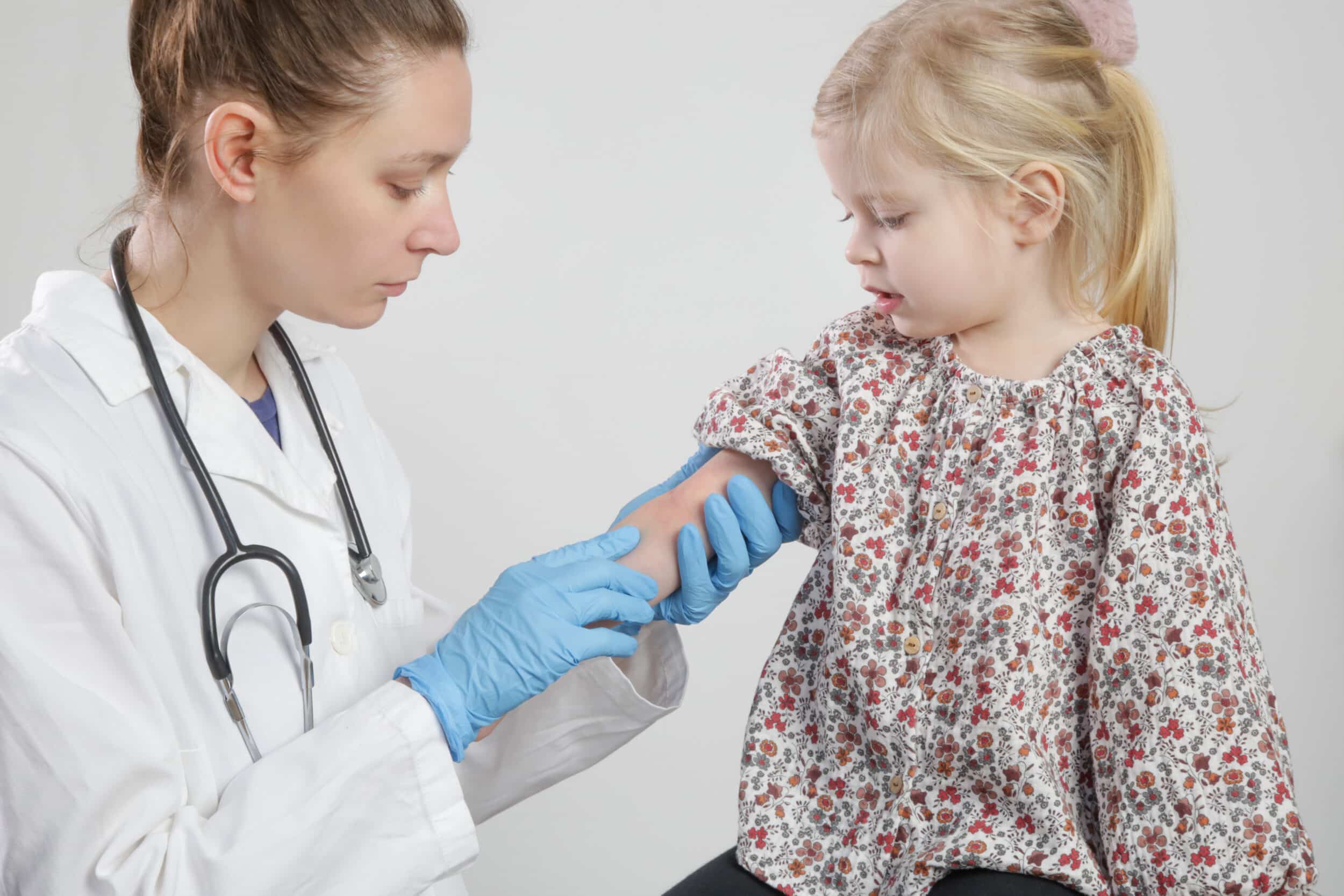 Diferencias en la apariencia del eccema en niños y adultos - Hollywood, FL